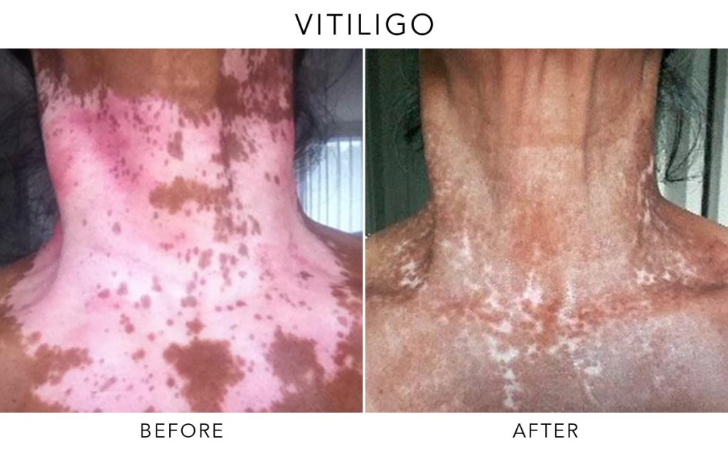 Exciplex® Excimer Light Machine – Cosmeditech