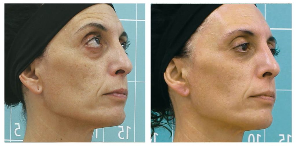 Symmed RF Face & Body Sculpting – Cosmeditech