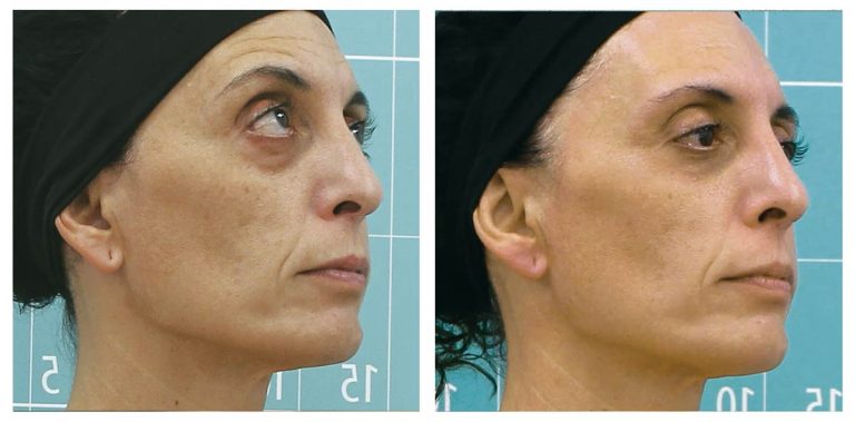 Symmed RF Face & Body Sculpting – Cosmeditech