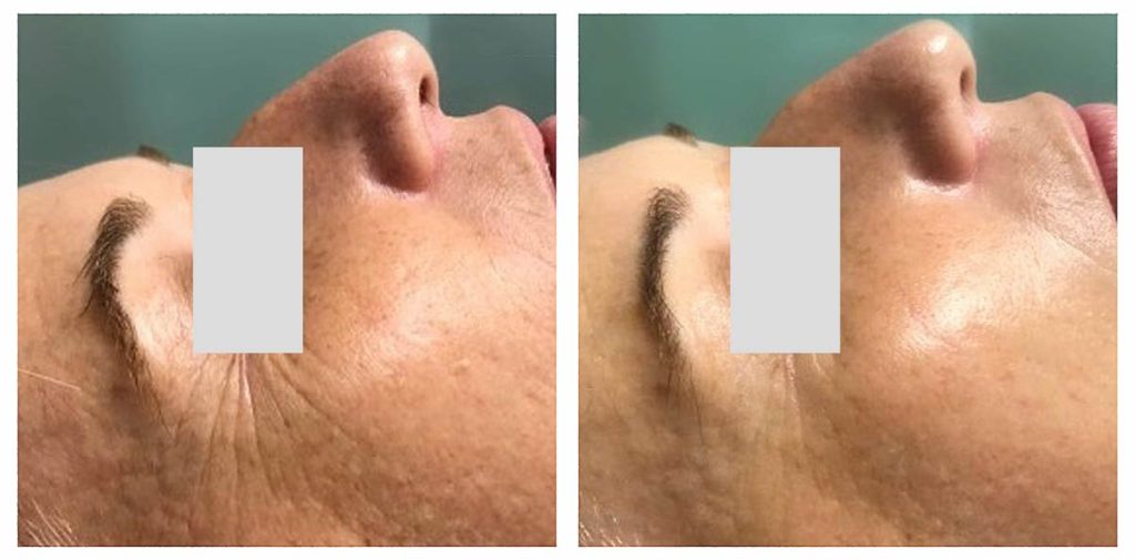 Symmed RF Face & Body Sculpting – Cosmeditech