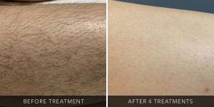 Eneka PRO Laser Hair Removal Machine – Cosmeditech