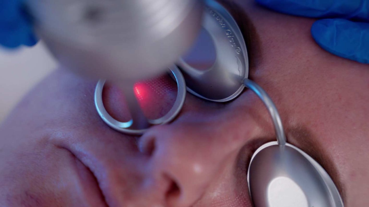 How does C02 fractional laser work – Cosmeditech