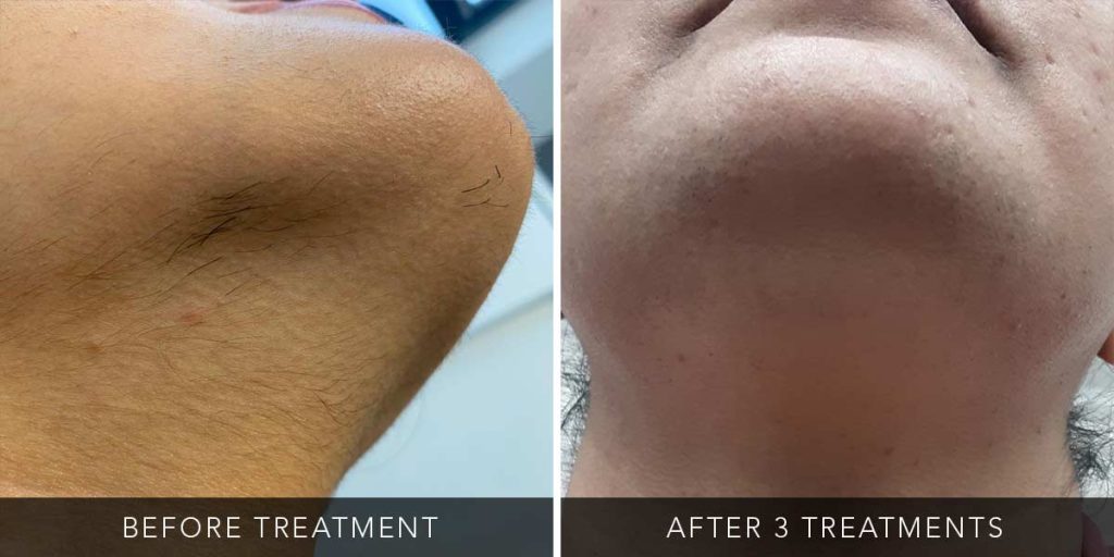 Eneka PRO Laser Hair Removal Machine – Cosmeditech