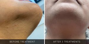 Eneka PRO Laser Hair Removal Machine – Cosmeditech